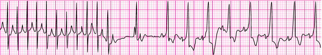 SVT Converting to Sinus Rhythm after Adenosine Admnistration | Time of Care